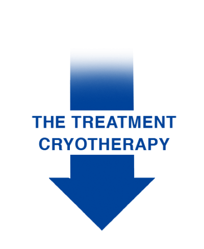 Verrukill CRYO the cryoterapy treatment - Verrukill