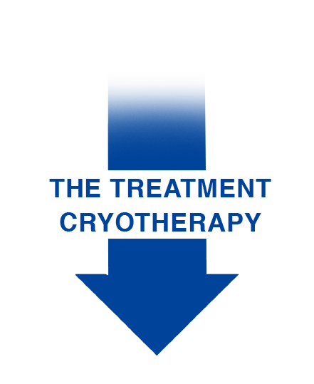 Verrukill CRYO the cryoterapy treatment - Verrukill